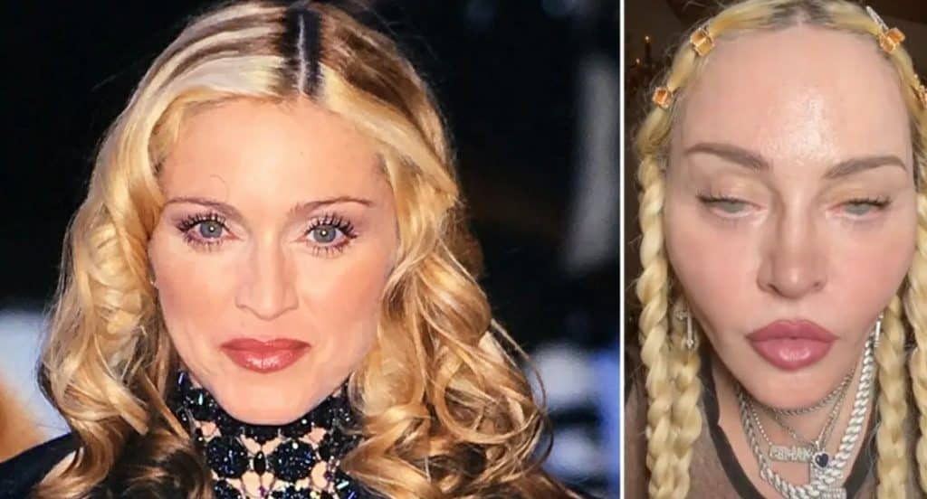 What Happened To Madonna's Face? The Queen Of Pop's Plastic Surgery ...