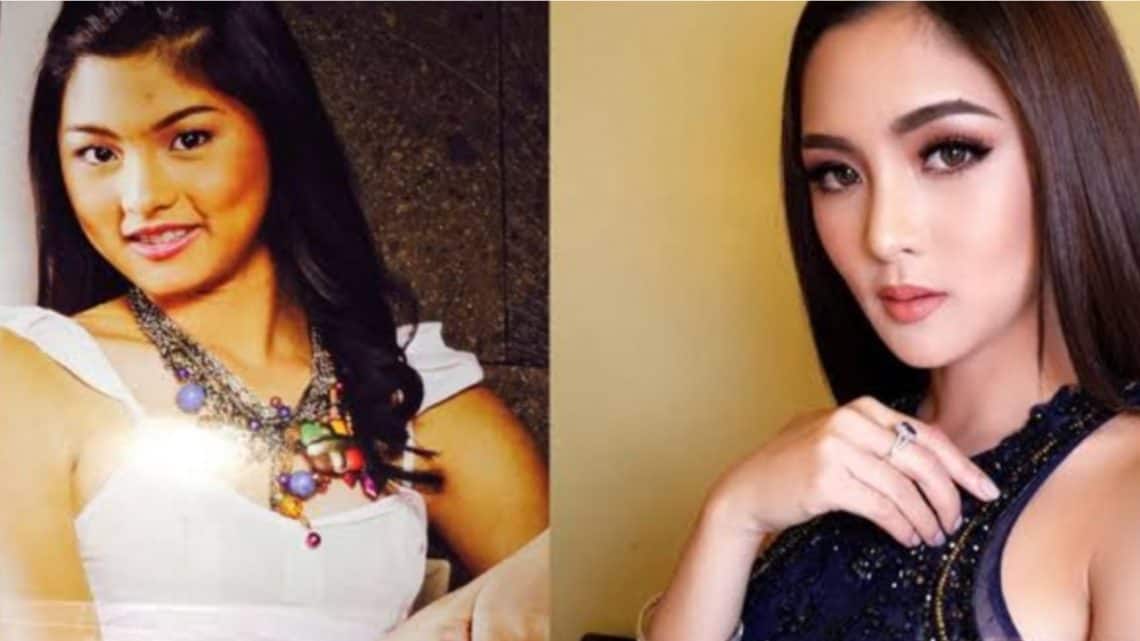 Kim Chiu's Before And After Looks: The Filipino Actress Sparks Plastic ...